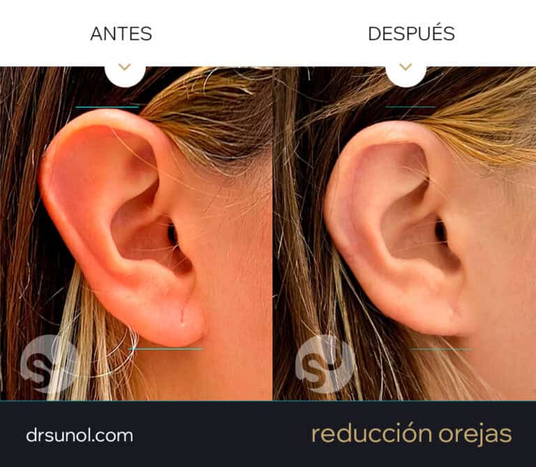 Reducción de orejas grandes | Dr. Joaquim Suñol Barcelona