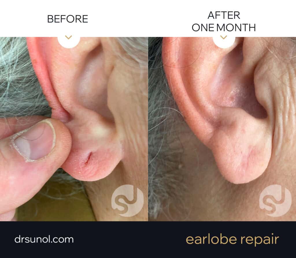 Lobuloplasty | Dr. Joaquim Suñol Clinic Barcelona