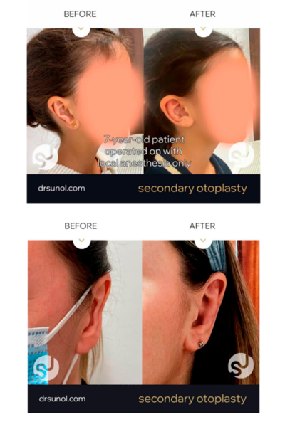 Before & After Otoplasty | Dr. Joaquim Suñol Clinic Barcelona